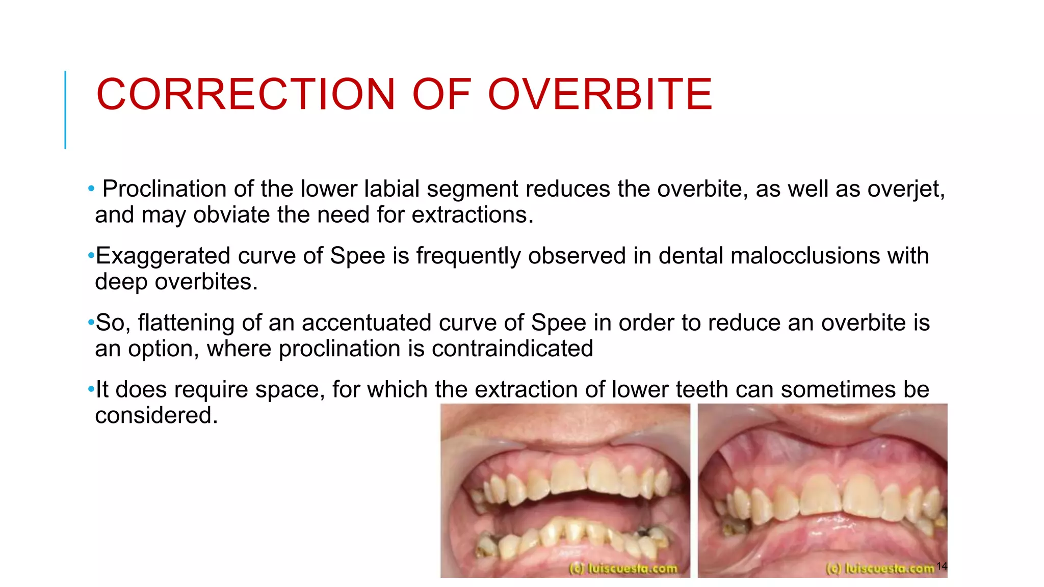 Extraction in orthodontics | PPTX