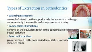 Extraction In Orthodontics when to do.pptx