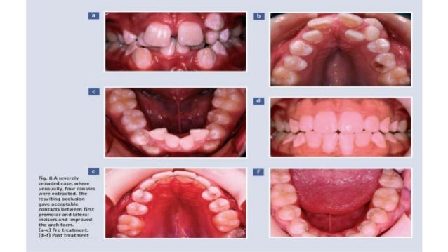 Extraction in orthodontics
