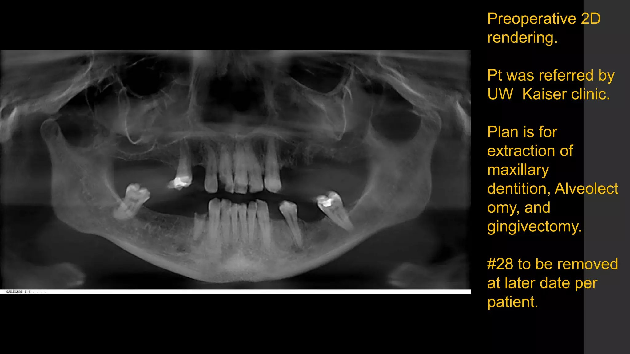 Extraction of maxillary anterior dentition, alveolectomy, gingivectomy ...