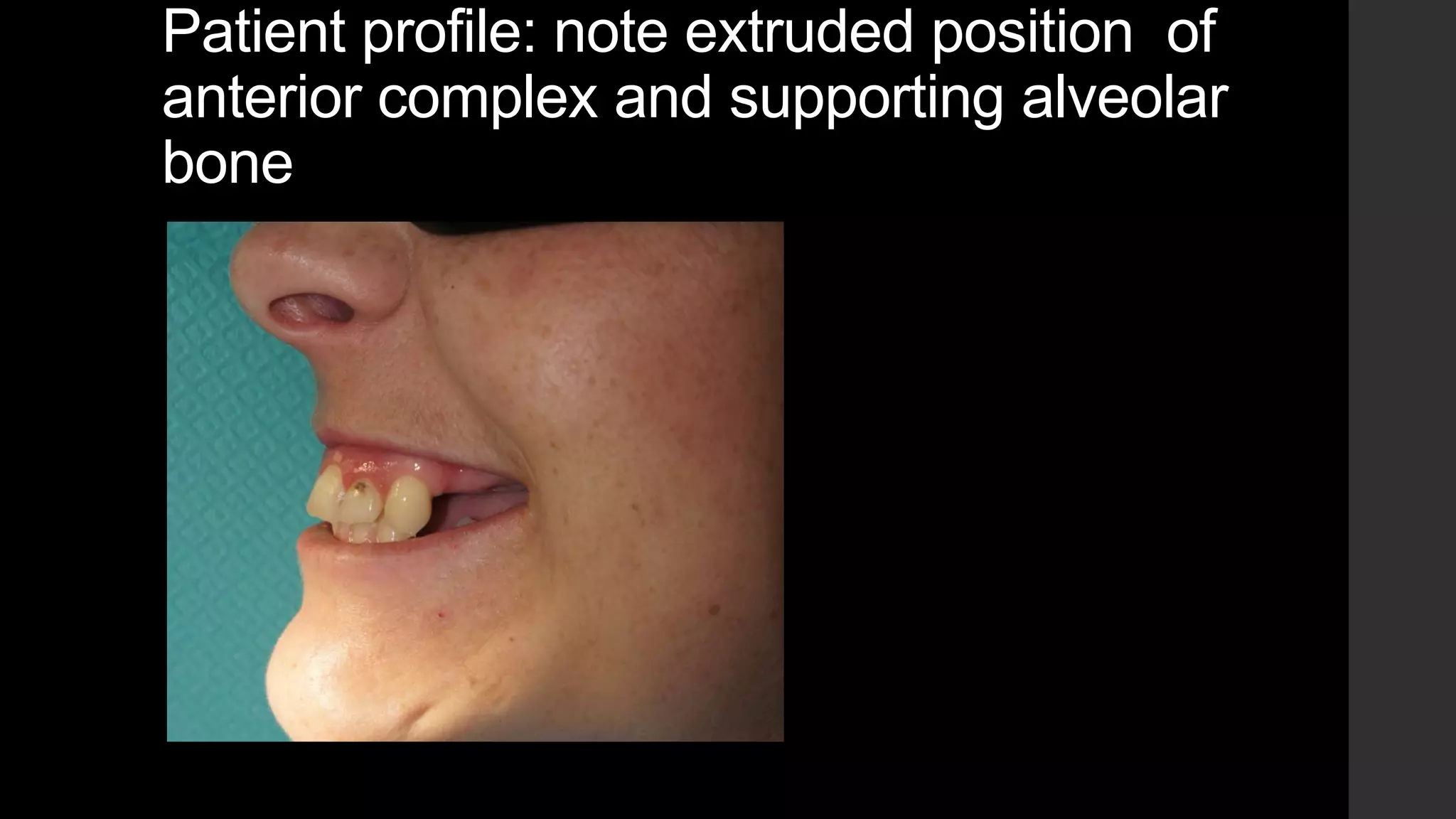 Extraction of maxillary anterior dentition, alveolectomy, gingivectomy ...