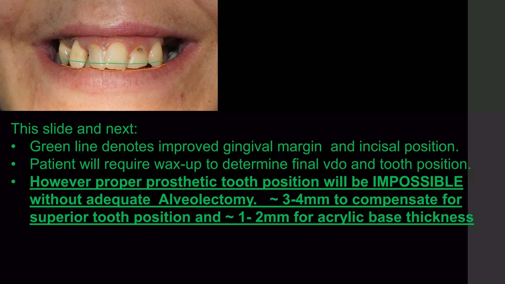 Extraction of maxillary anterior dentition, alveolectomy, gingivectomy ...
