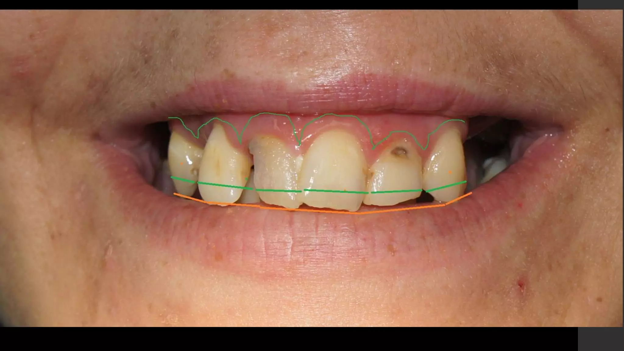 Extraction of maxillary anterior dentition, alveolectomy, gingivectomy ...