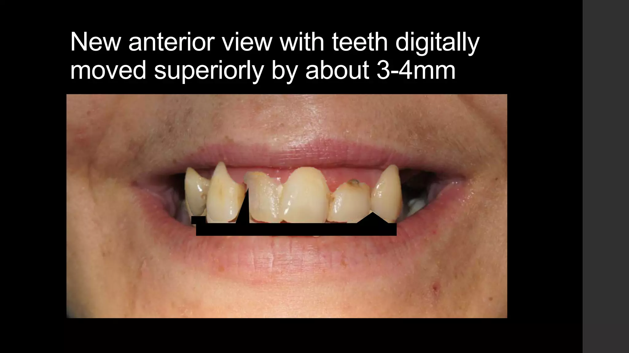 Extraction of maxillary anterior dentition, alveolectomy, gingivectomy ...