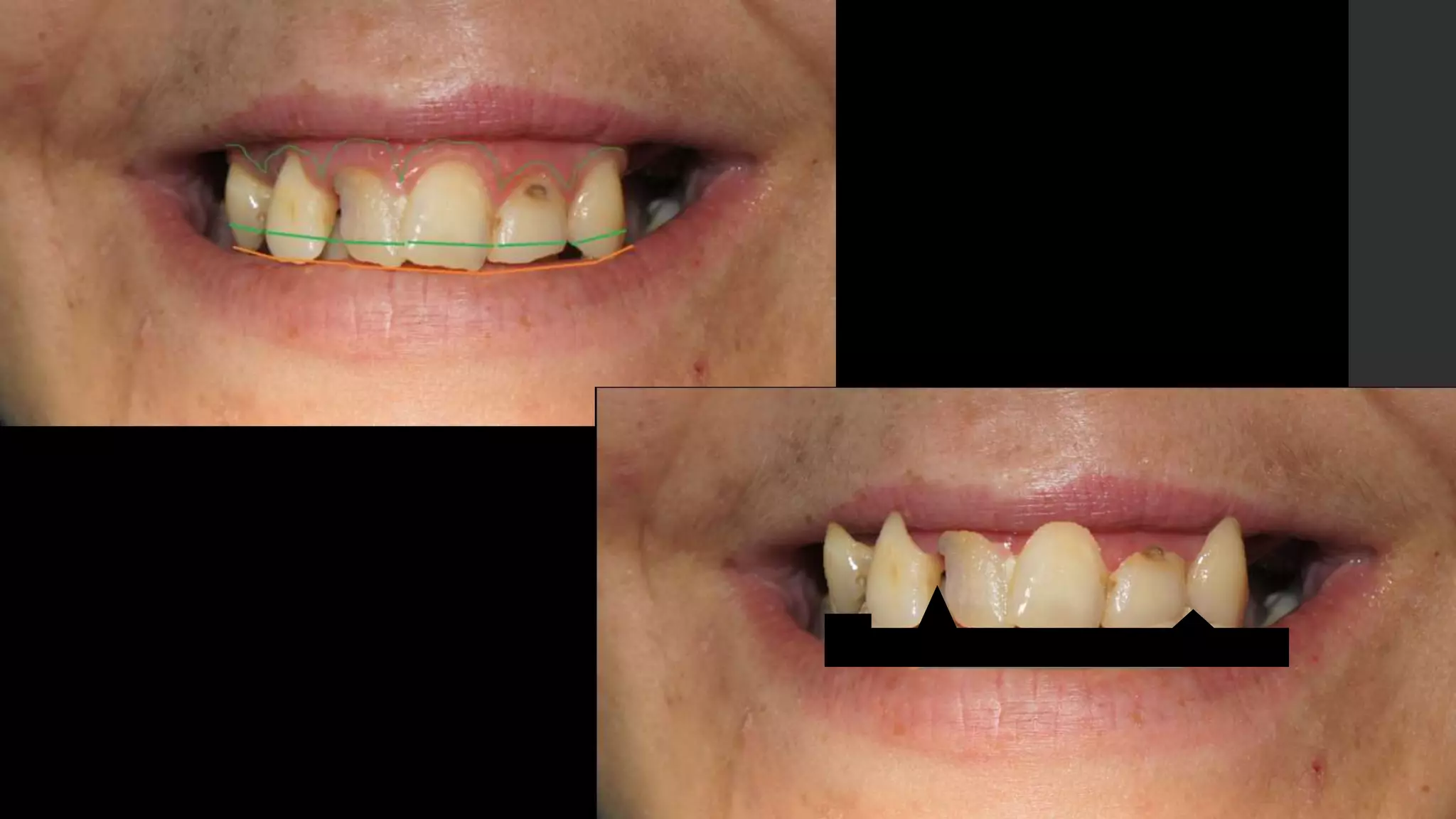 Extraction of maxillary anterior dentition, alveolectomy, gingivectomy ...