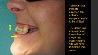 Extraction of maxillary anterior dentition, alveolectomy, gingivectomy ...