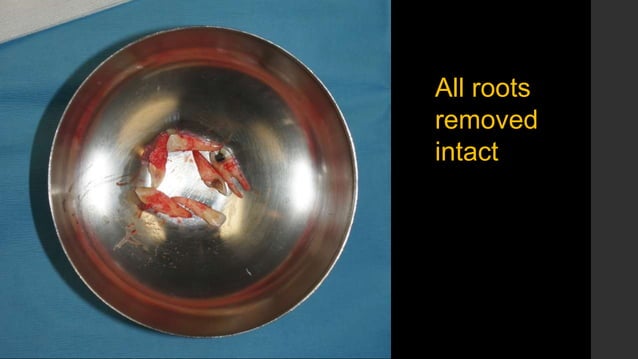 Extraction of maxillary anterior dentition, alveolectomy, gingivectomy ...