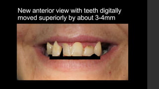 Extraction of maxillary anterior dentition, alveolectomy, gingivectomy ...