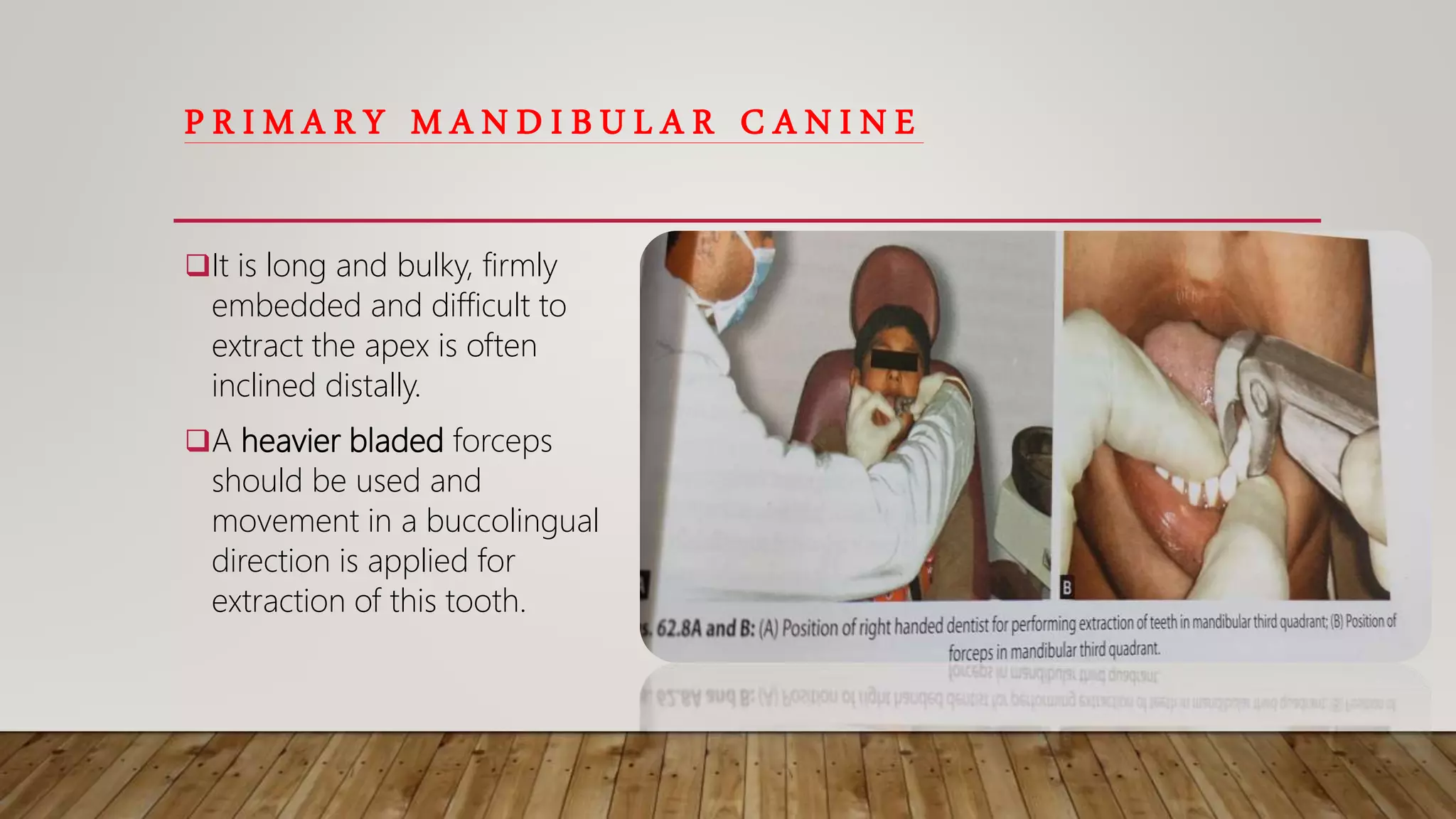 Extraction of primary teeth along with permanent teeth | PPTX