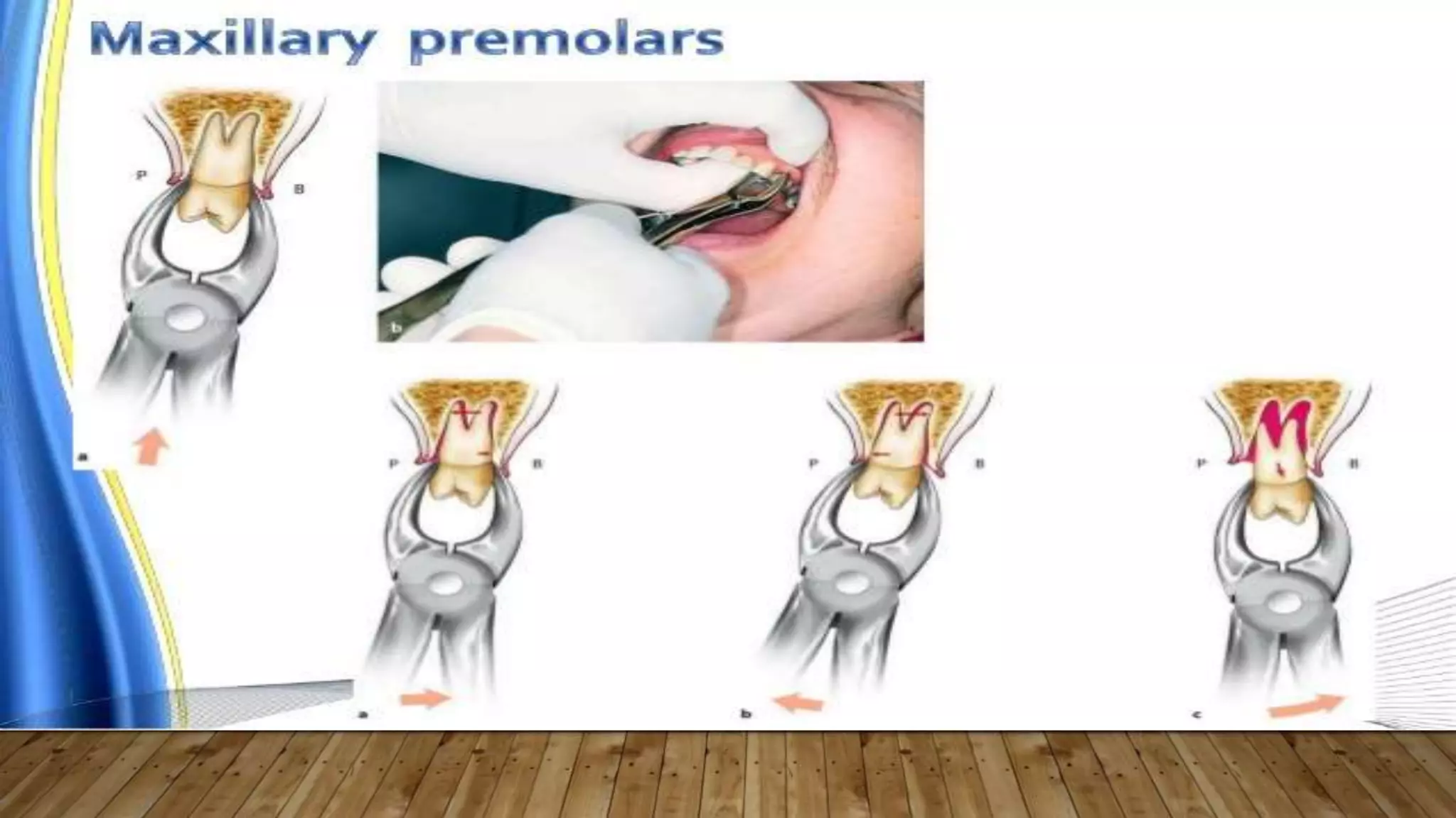 Extraction of primary teeth along with permanent teeth | PPTX