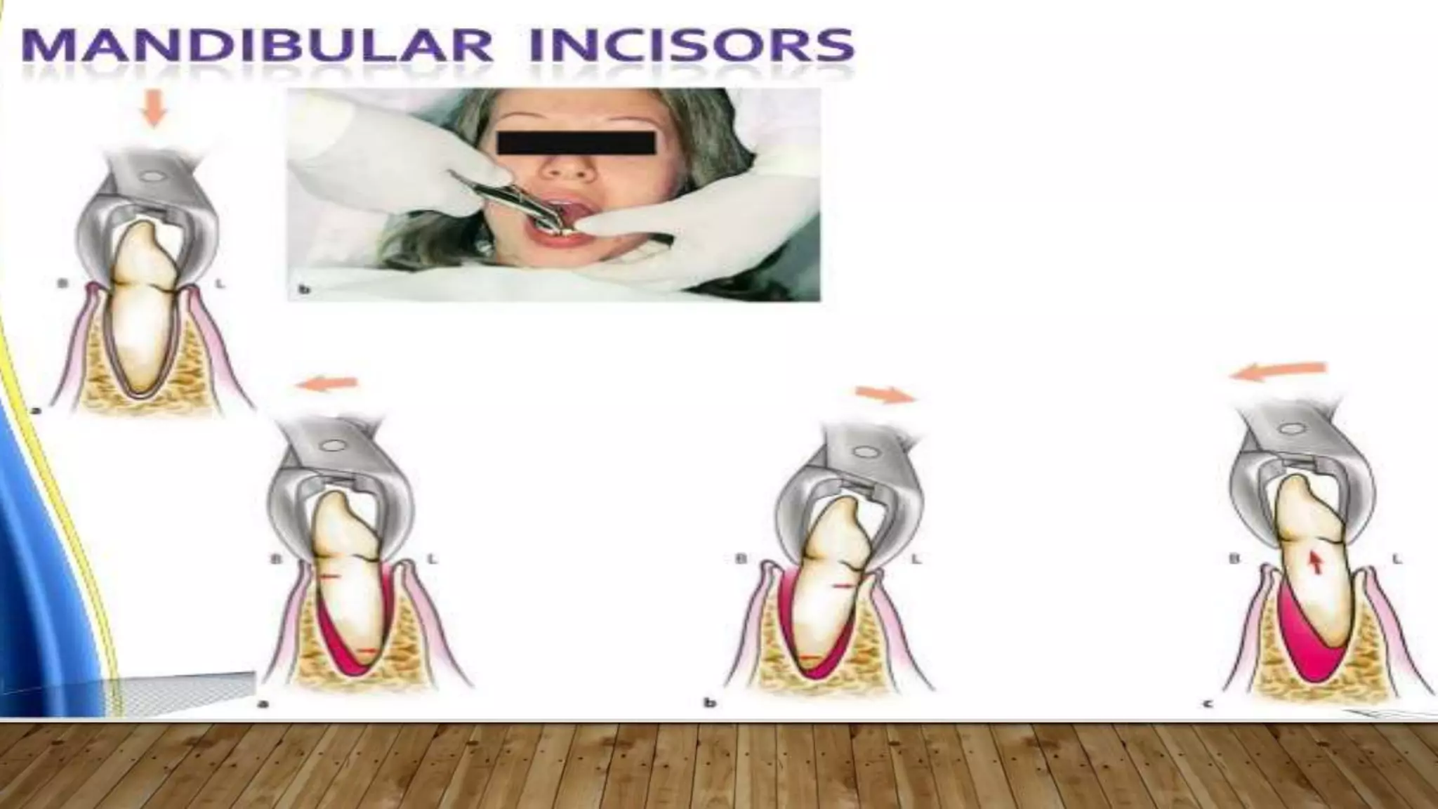 Extraction of primary teeth along with permanent teeth | PPTX