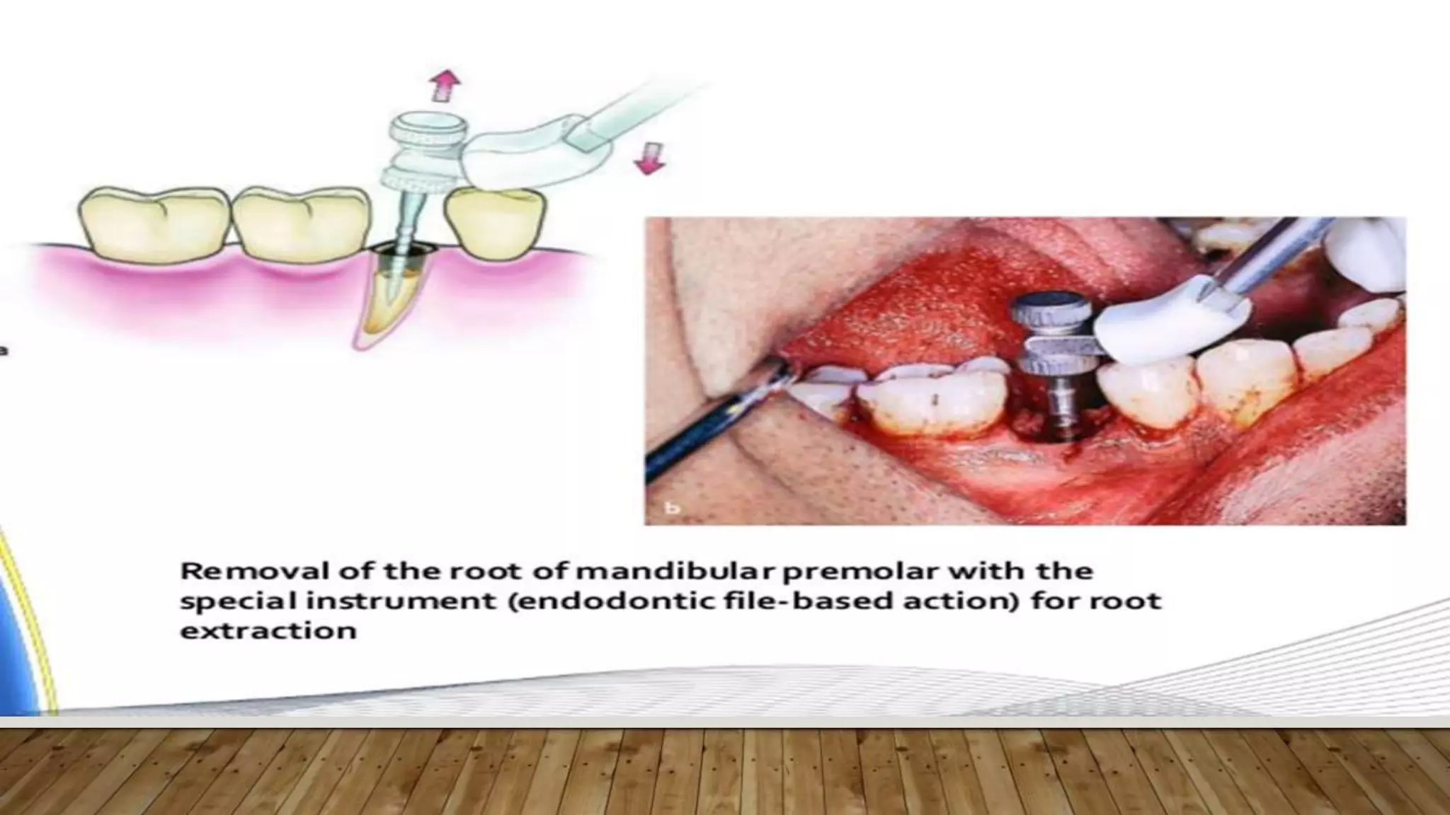Extraction of primary teeth along with permanent teeth | PPTX