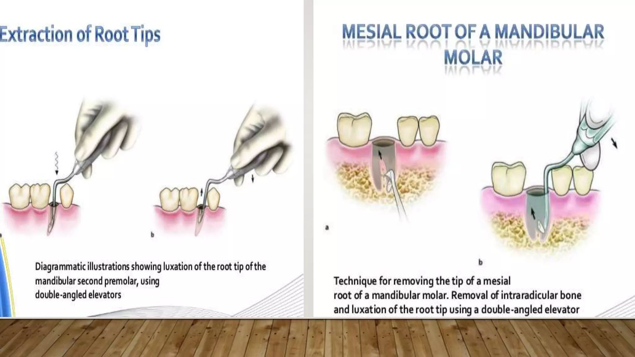 Extraction of primary teeth along with permanent teeth | PPTX
