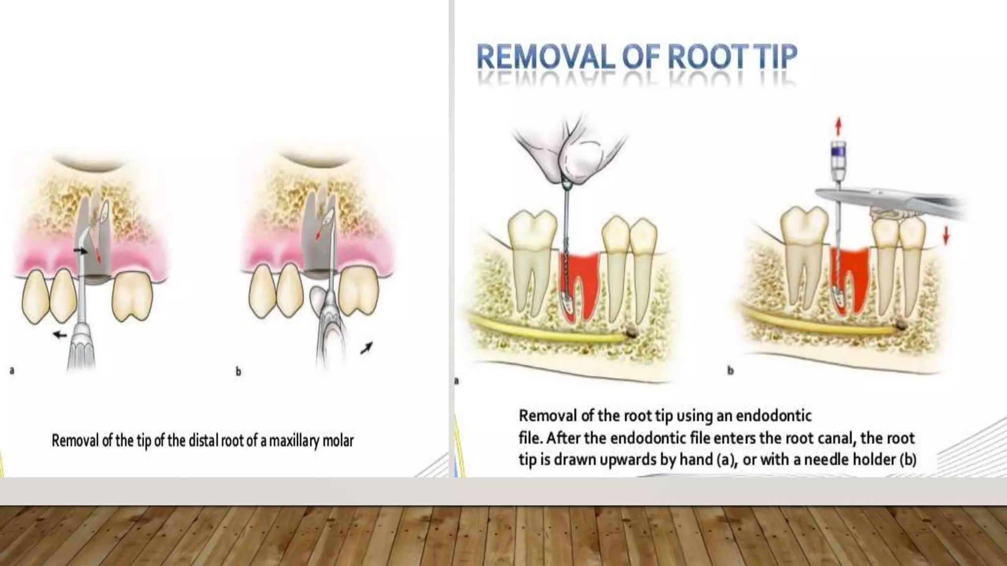 Extraction of primary teeth along with permanent teeth | PPTX