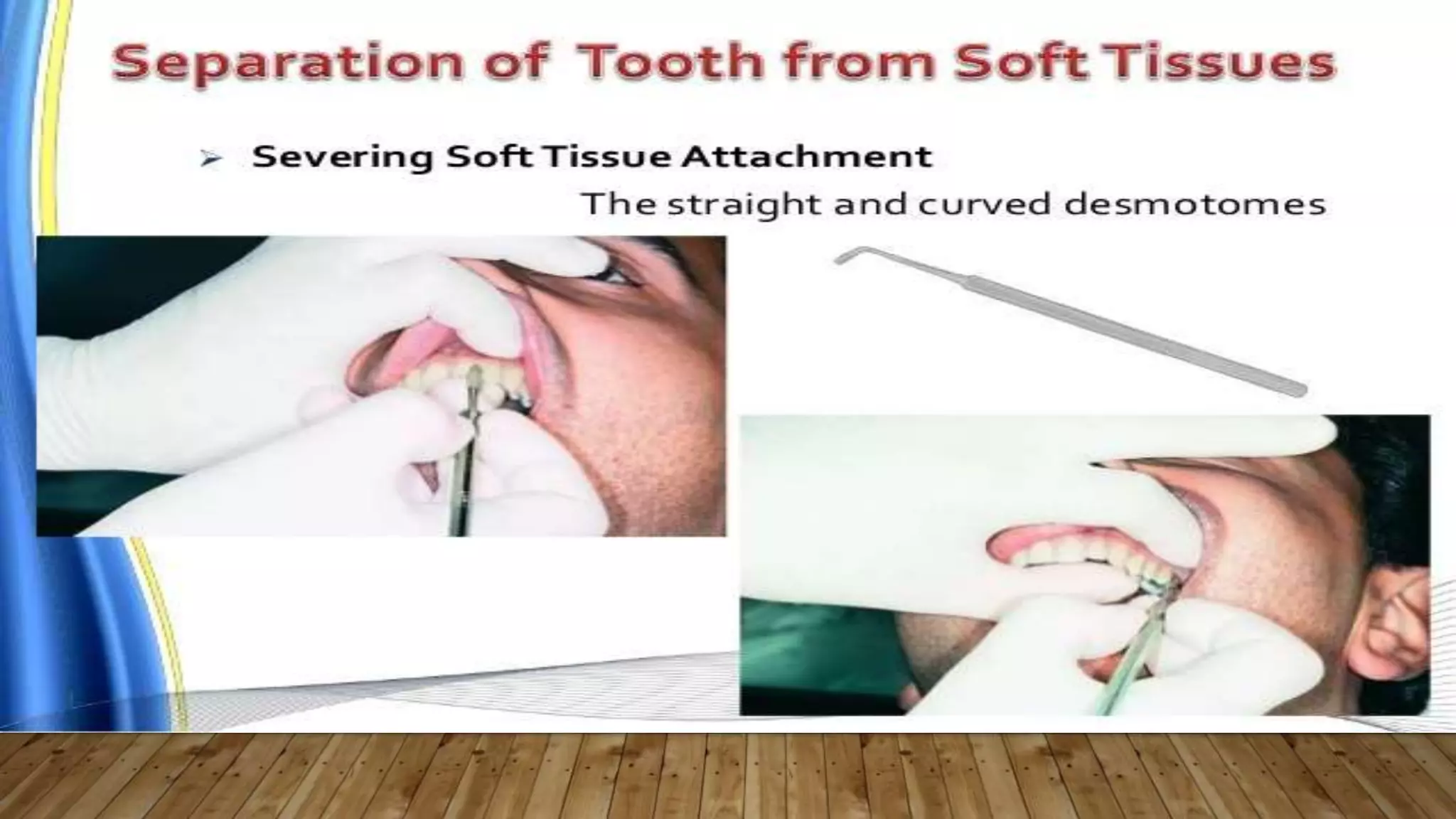 Extraction of primary teeth along with permanent teeth | PPTX