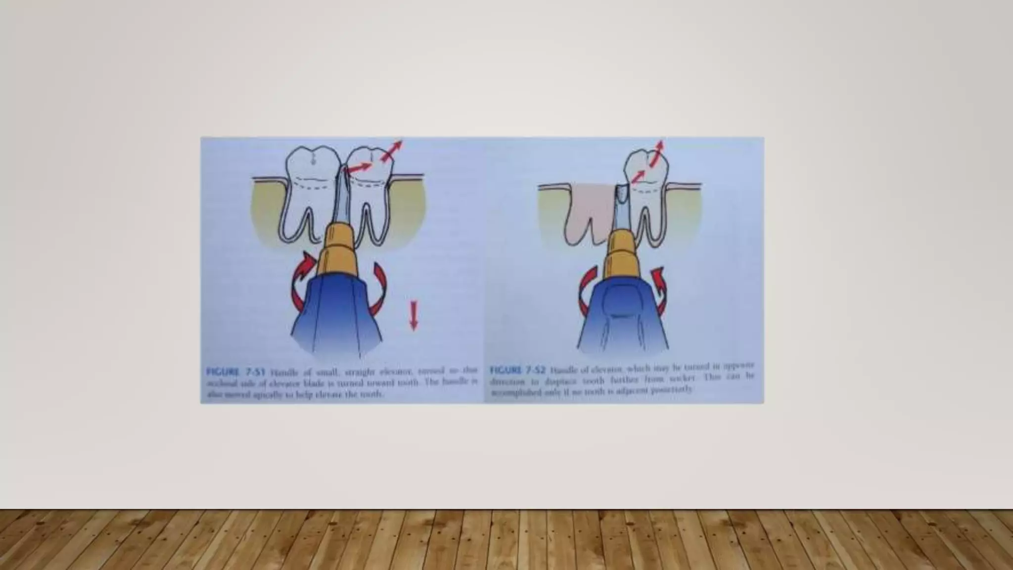 Extraction of primary teeth along with permanent teeth | PPTX