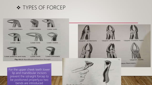 Extraction of primary teeth along with permanent teeth | PPTX