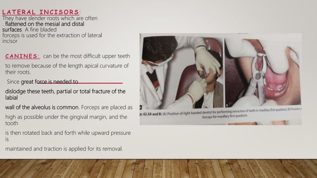 Extraction of primary teeth along with permanent teeth | PPTX