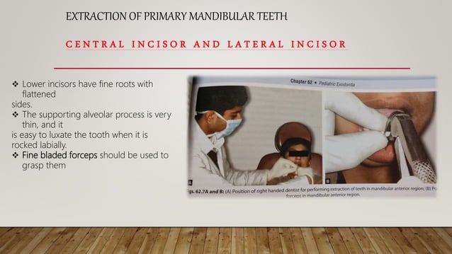 Extraction of primary teeth along with permanent teeth | PPTX