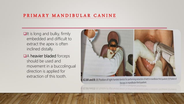 Extraction of primary teeth along with permanent teeth | PPTX