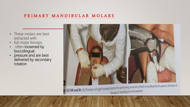 Extraction of primary teeth along with permanent teeth | PPTX