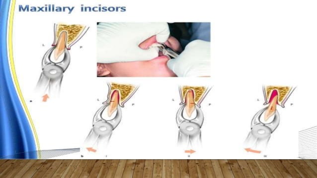 Extraction of primary teeth along with permanent teeth | PPTX