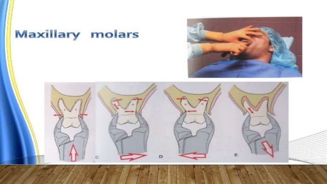 Extraction of primary teeth along with permanent teeth | PPTX