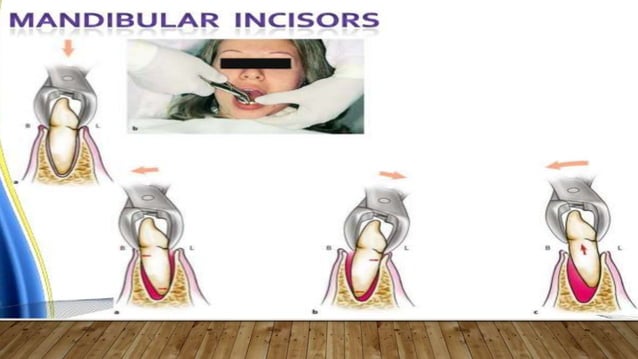 Extraction of primary teeth along with permanent teeth | PPTX
