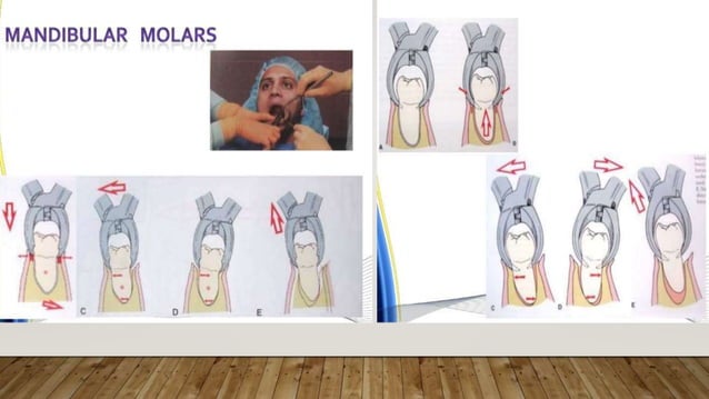 Extraction of primary teeth along with permanent teeth | PPTX