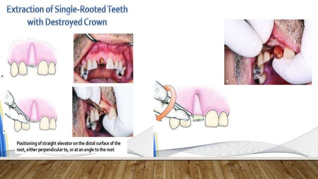 Extraction of primary teeth along with permanent teeth | PPTX