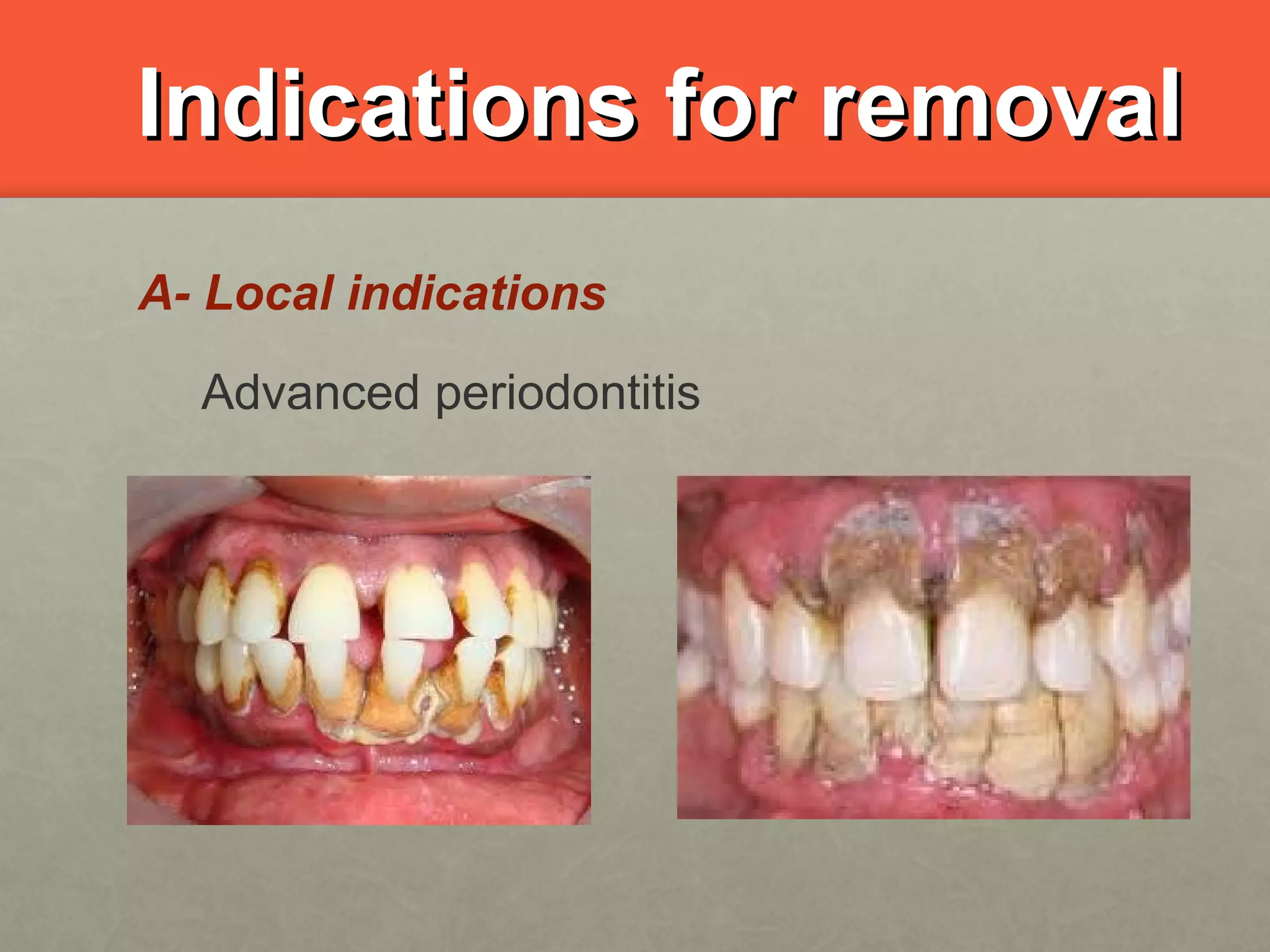 Extraction of teeth | PPT