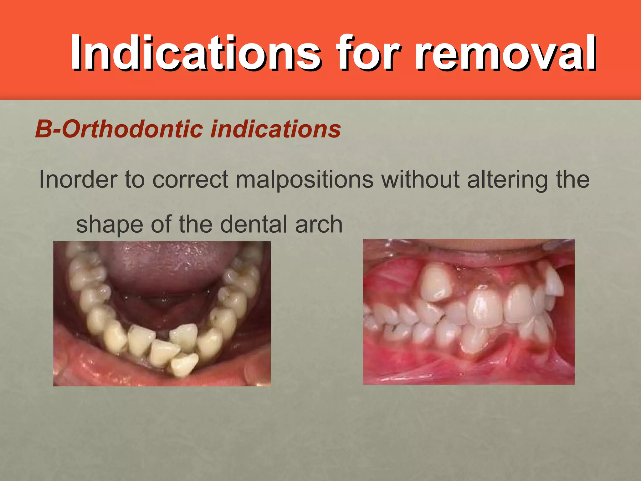 Extraction of teeth | PPT