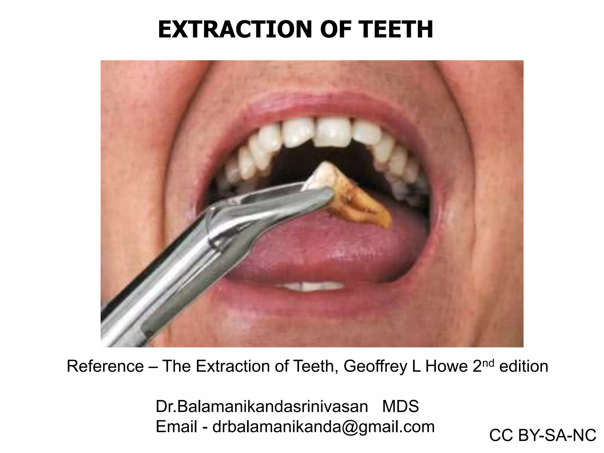 Extraction of teeth swayam week 14 sa 2 | PPT