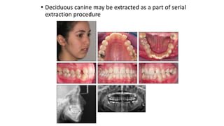 Extractions in orthodontics.pptx