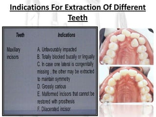 Extractions in orthodontics ug | PPTX