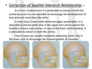Extractions in orthodontics ug | PPTX