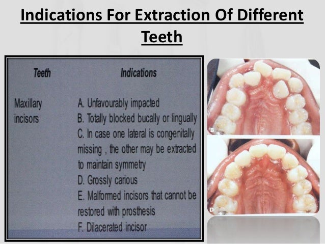 Extractions in orthodontics ug