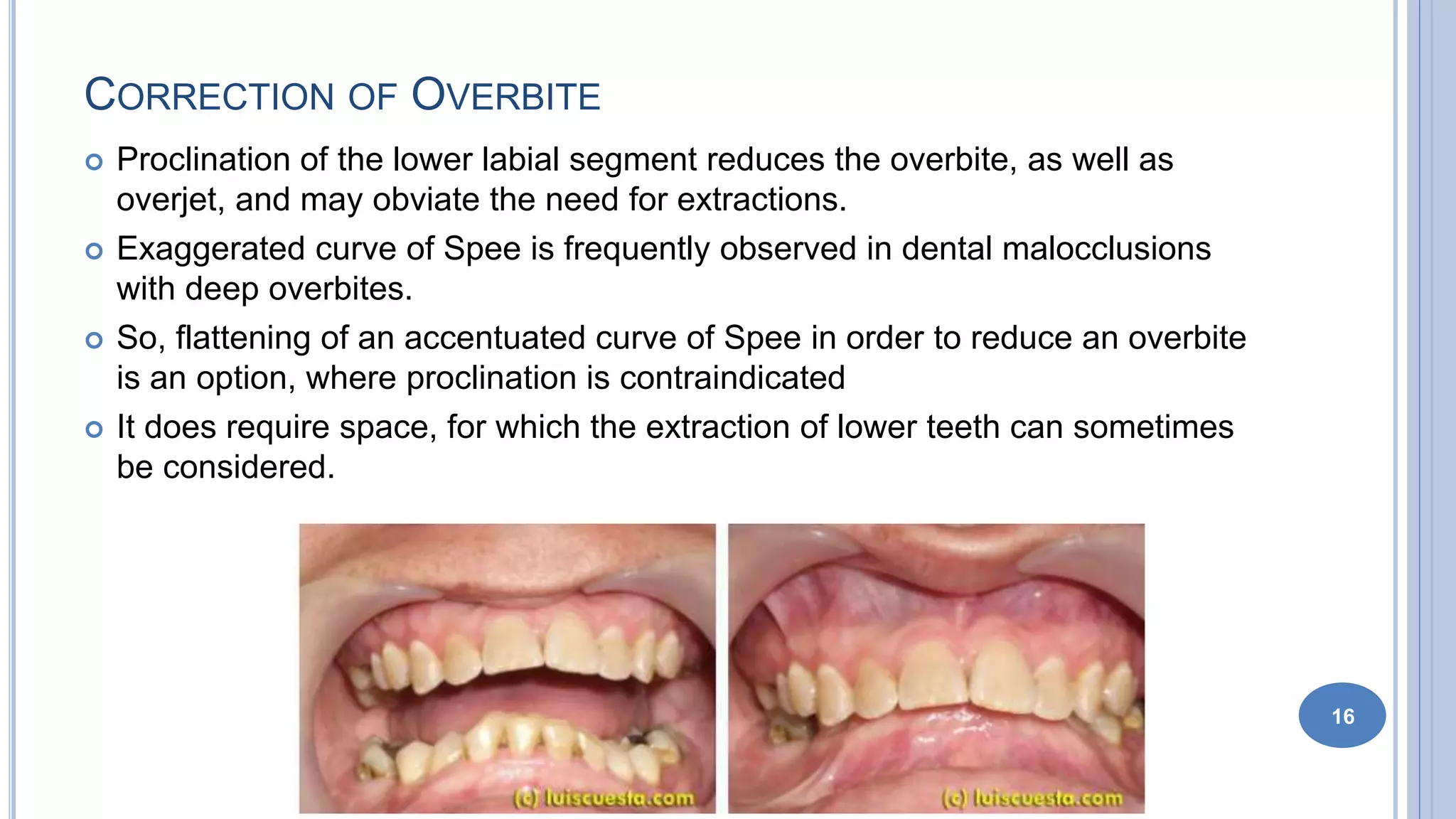 Extractions in Orthodontics Journal Club Presentation | PPTX