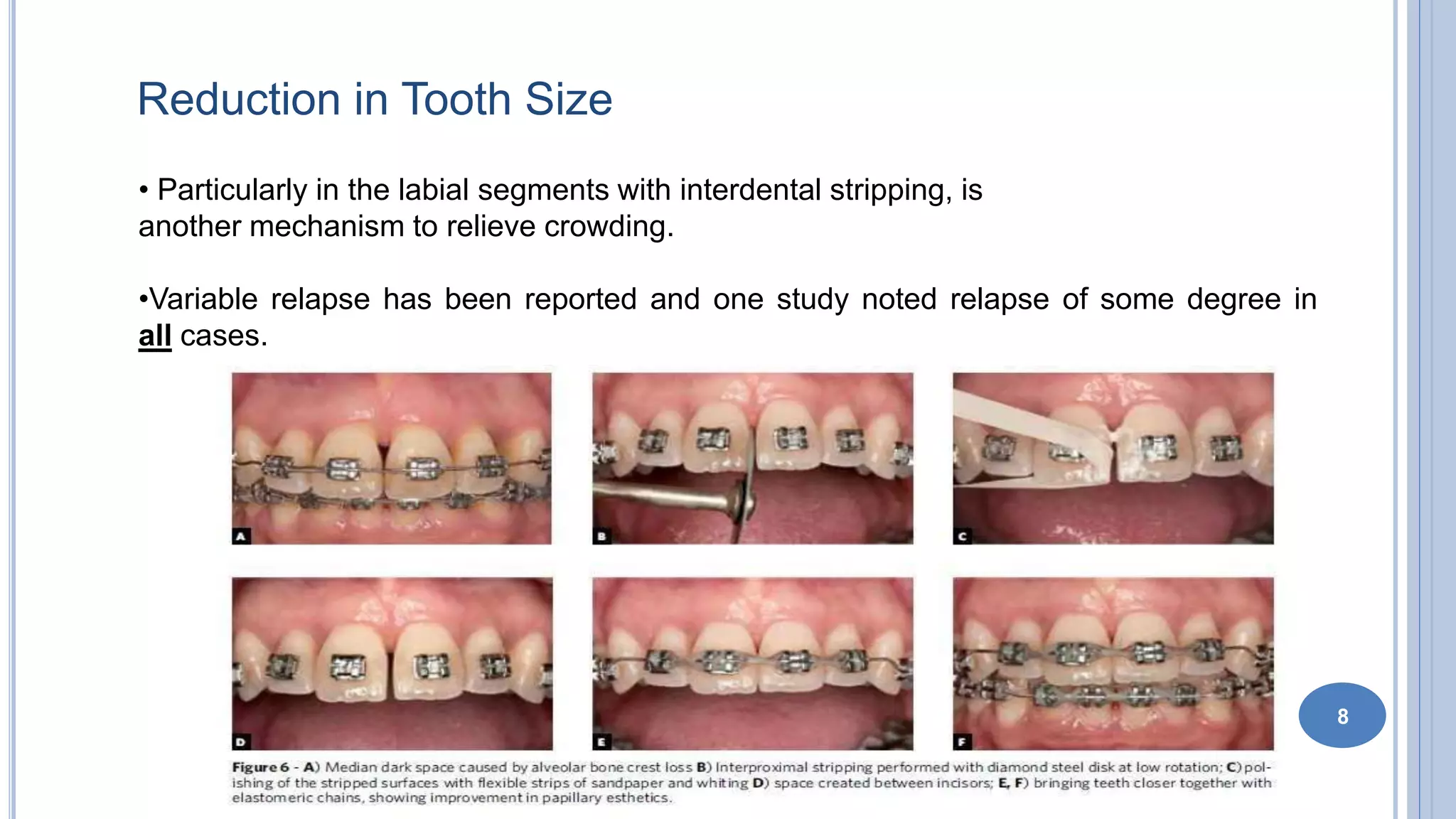 Extractions in Orthodontics Journal Club Presentation | PPTX