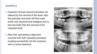 Extractions in Orthodontics Journal Club Presentation | PPTX
