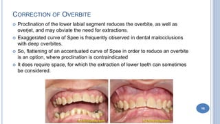 Extractions in Orthodontics Journal Club Presentation | PPTX