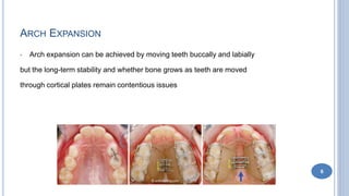 Extractions in Orthodontics Journal Club Presentation | PPTX