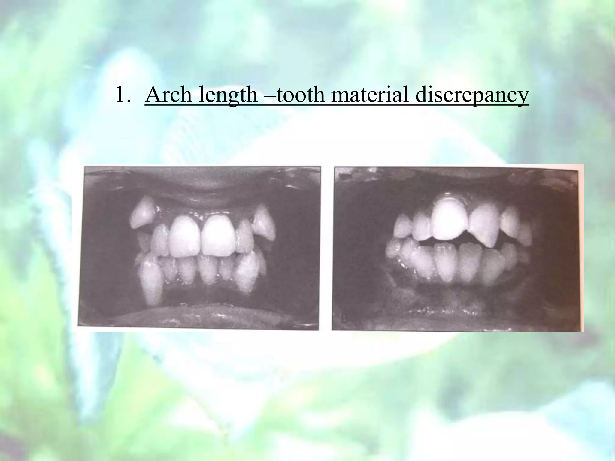 Extractions in Orthodontics O.ppt