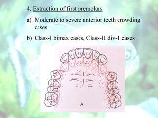Extractions in Orthodontics O.ppt