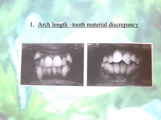 Extractions in Orthodontics O.ppt