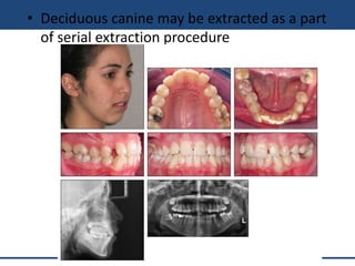 Extractions | PPT