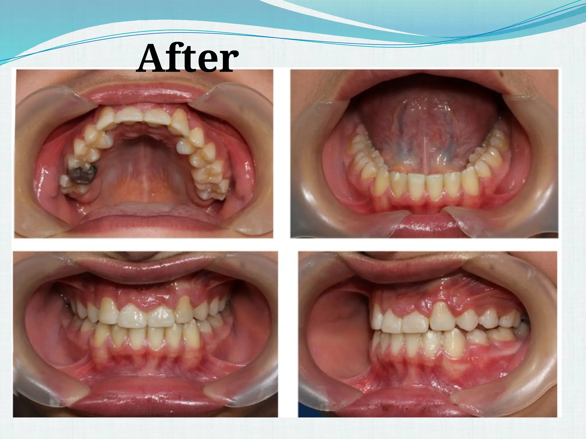 extractionteethforgainingspaceinorthodontics.pptx | Dental Health ...