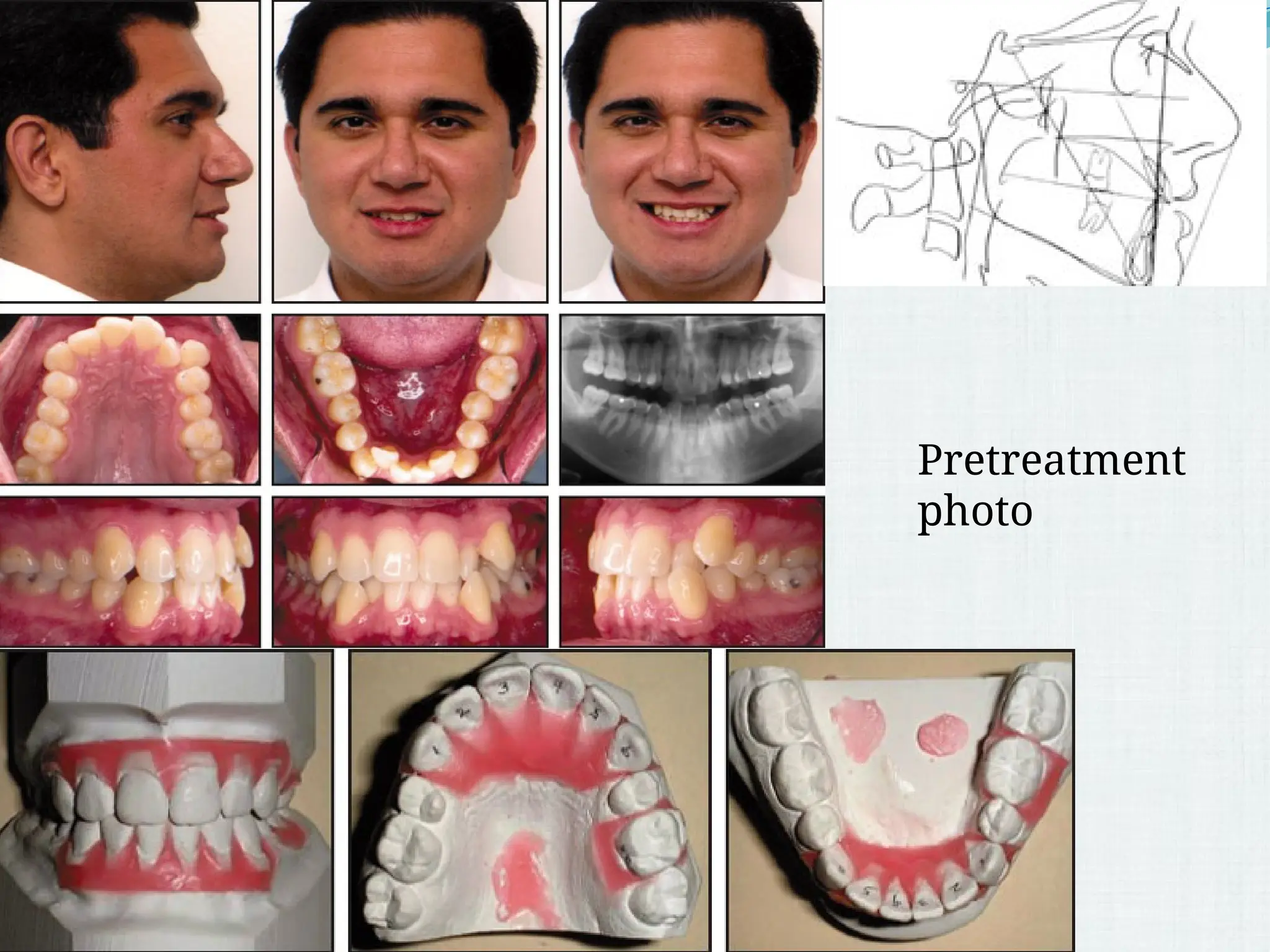 extractionteethforgainingspaceinorthodontics.pptx | Dental Health ...