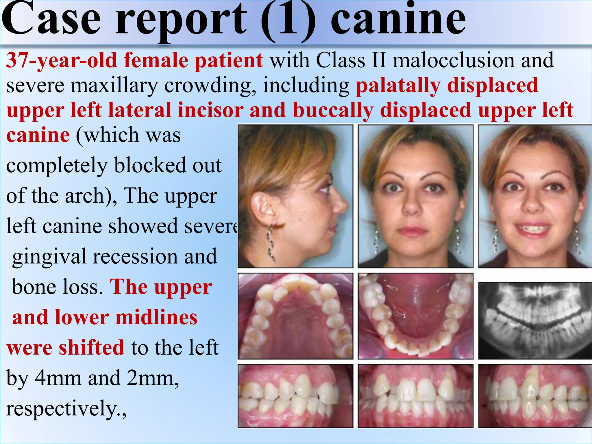 Extraction teeth for gaining space in orthodontics | PPT