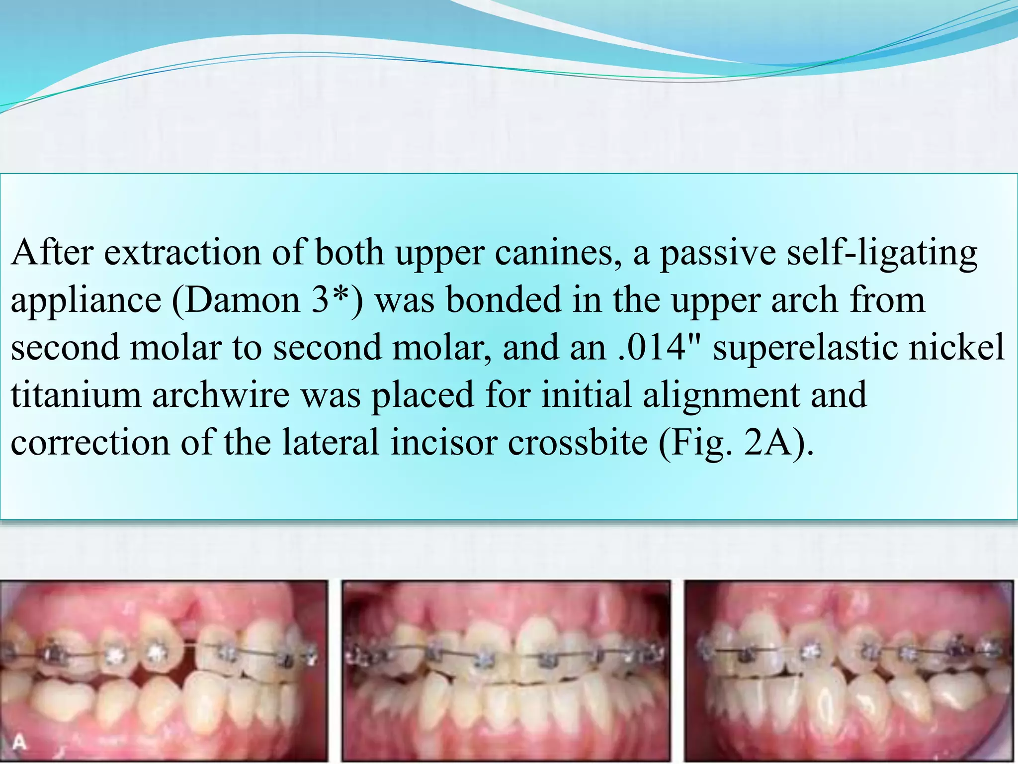 Extraction teeth for gaining space in orthodontics | PPTX